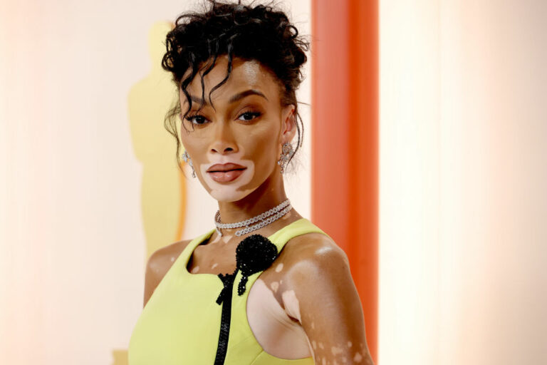 Winnie Harlow pokazala tijelo s vitiligom na naslovnici časopisa "Women ...